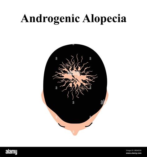 Alopecia Hair Baldness Of Hair On The Head Androgenic Alopecia