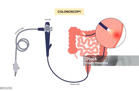 Colonoscopy Medical Procedure Stock Illustration Download Image Now