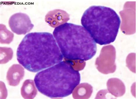 Hematology Lecture 18 Acute Leukemia Flashcards Quizlet