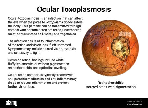 Ocular Toxoplasmosis A Disease Caused By The Single Celled Protozoan Toxoplasma Gondii
