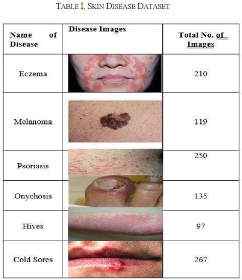 Table I From Real Time Skin Disease Prediction System Using Deep