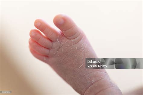 팔 Mo발바닥 건 선 알레르기 접촉 Dermatits 및 유아에 있는 아 토 피 성 피부염 건강 진단에 대한 스톡 사진 및 기타