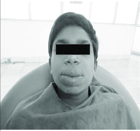 Swelling Of The Upper And Lower Lip Download Scientific Diagram