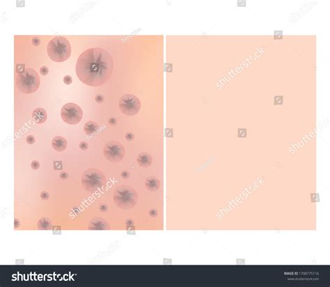 Texture Acne Scars Acne Before After Vector Có Sẵn Miễn Phí Bản Quyền