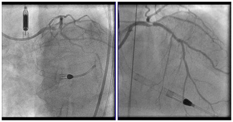 Case IVUS Guided LM Trifurcation PCI Cardiology Apps
