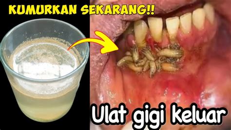 Semua Bahagia Cara Mengobati Sakit Gigi Berlubang Secara Alami Sembuh