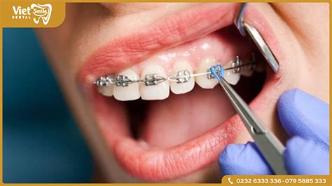 Giai đoạn đóng khoảng trong niềng răng mất bao lâu Nha Khoa Quốc Tế Việt Smile