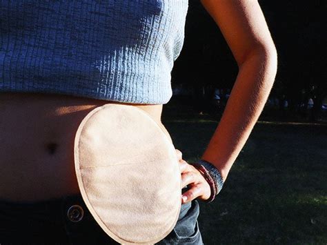 Discover More Than 80 Colostomy Bag Pictures Super Hot In Duhocakina