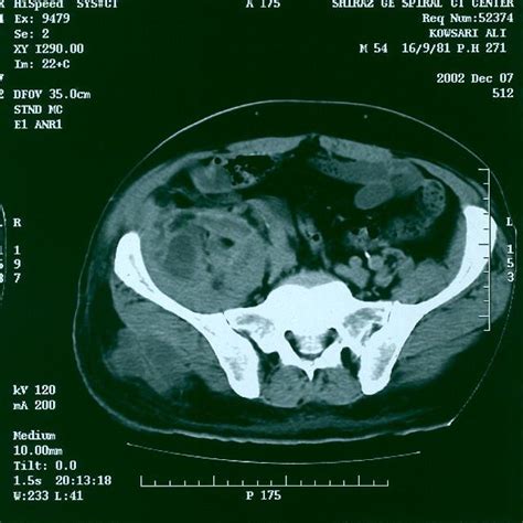 Section Of The Appendix Hyperplasia Of The Lymphatic Tissue Is Evident