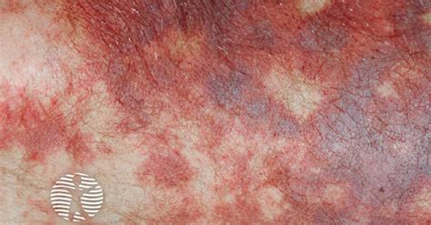 Purpura Fulminans Image