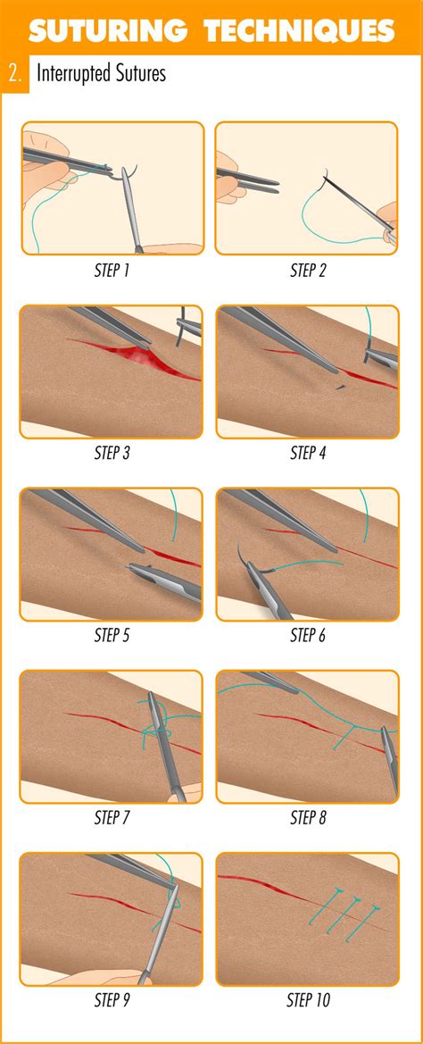 Different Types Of Suture Stitches At Margaret Bower Blog