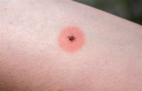 Tick Bite Fever Recovery Time