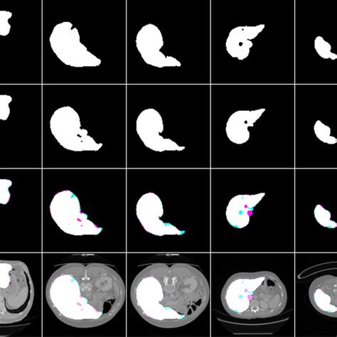 Tumor Segmentation Results From The Liver With The Respective Masks And Download Scientific