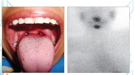 1552383311650 1552296690783 1 Management Of Hypothyroidism Pptx