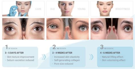 Buy Wholesale China Korea Ami Eyes 2 Ml 1 Collagen Filler Dermals