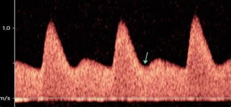 Uterine Artery Doppler
