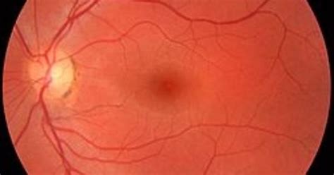 Fundus Photo Album On Imgur