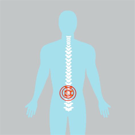 Lumbar Rfa Radiofrequency Ablation Synergy Health Partners
