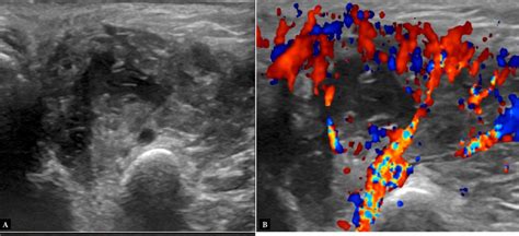 Intraparotid Abscess B Mode A Enlarged Heterogeneous Right Parotid
