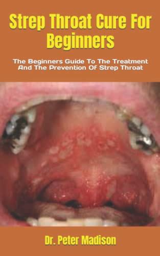Strep Throat Cure For Beginners The Beginners Guide To The Treatment