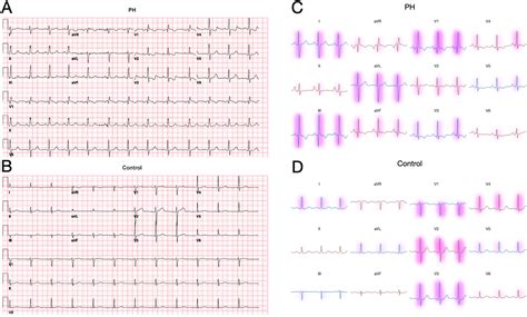 Electrocardiogram Detection Of Pulmonary Hypertension Using Deep