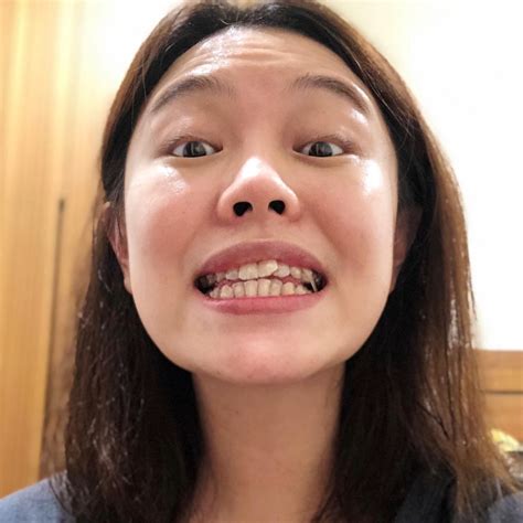 排列擁擠 1y5m｜歷時一年多將門牙歸隊啦！門牙矯正推薦樂齒微矯正，矯正費用透明化最放心！