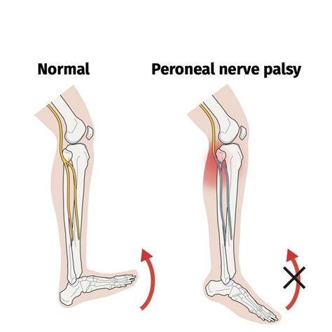 Peroneal Nerve Palsy