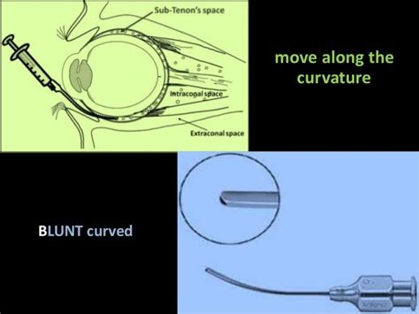 Anesthesia In Ophthalmic Surgery