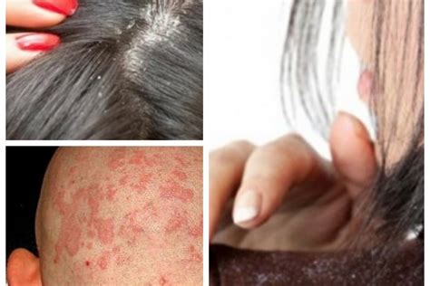 Effectively Managing And Minimising Symptoms Of Scalp Eczema Makeup Files