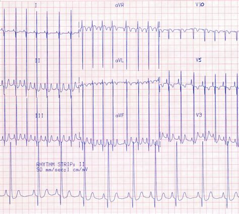 Patent Ductus Arteriosus CardioRush