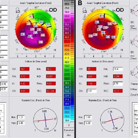 topometric difference map comparing the anterior curvature parameters
