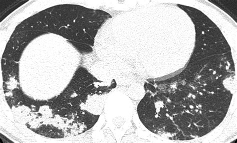 Pulmonary Cryptococcosis In Immunocompetent Patients Ct Findings In 12