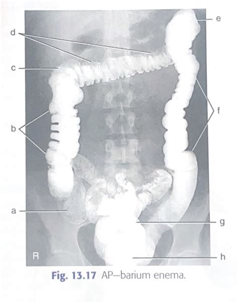 Ap Barium Enema Diagram Quizlet