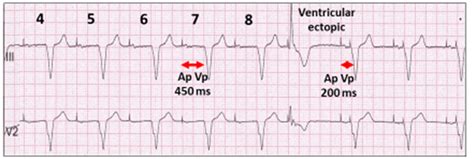 Ventricular Pacing Minimisation Algorithms