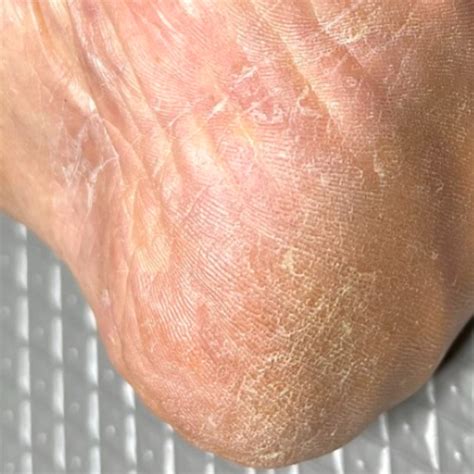 수포형 무좀 발가락 수포 발습진 발백선 발냄새 원인