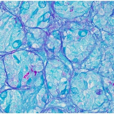 Ill Defined Granulomas And Clusters Of Small Extracellular White