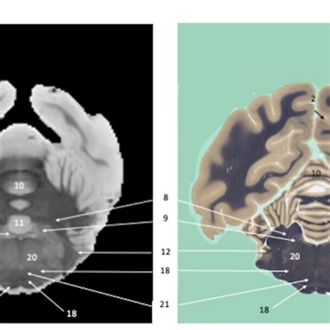 Figure Tranverse Section Of The Myelencephalon And Cerebellum At The