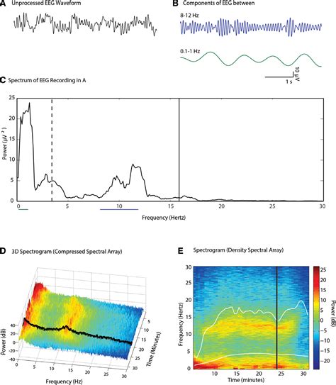 Figure 1 From The Electroencephalogram And Brain Monitoring Under