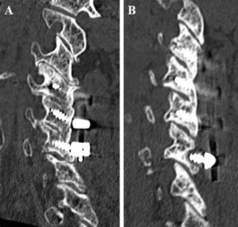 Risk Factor Analysis Of Facet Fusion Following Cervical Lateral Mass