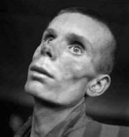 Истощенный узник концлагеря Дахау, больной дизентирией — военное фото
