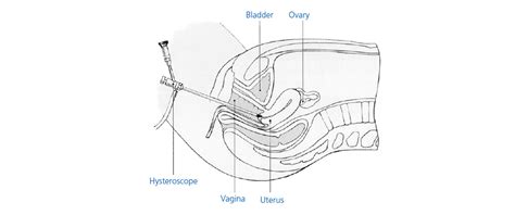Hysteroscopy Clinic South Tees Hospitals Nhs Foundation Trust