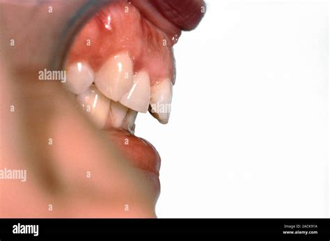Maxillary Prognathism Clinical View Of The Teeth Of An Orthodontic Patient In A Case Of