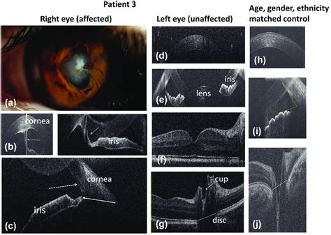 Anterior Segment Photography A And Spectral Domain Optical Coherence Download Scientific