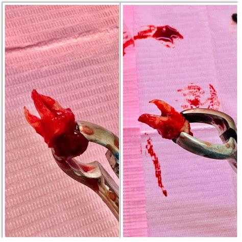 Dr Fathima Yasmine On Linkedin Grossly Decayed Upper Third Molar