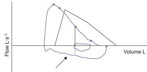Vocal Cord Dysfunction Vcd Severe Asthma Toolkit