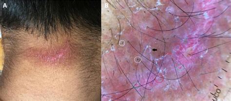 A Clinical Image Of Healed Lesion Of Blister Beetle Dermatitis Over
