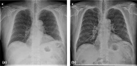 Disseminated Tb
