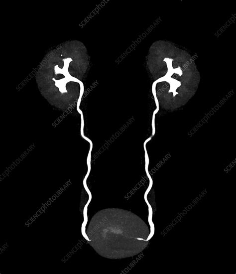 Urinary System Ct Scan Stock Image F037 7268 Science Photo Library
