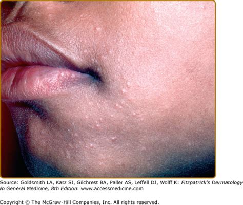 Papular Sarcoidosis