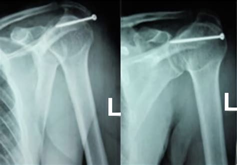Postoperative Control X Ray Showing The Acromion Fracture Fixed With A Download Scientific